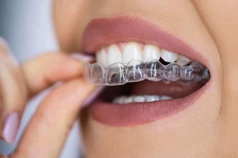Night Guards in Austin | Sports Mouth Guard | Austin City Dental